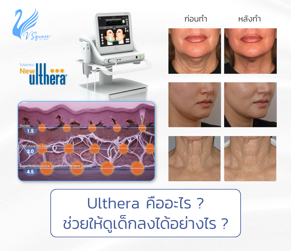 Ulthera คืออะไร? ช่วยเรื่องอะไร เจ็บไหม ราคาเท่าไร ตอบทุกข้อสงสัยที่อยากรู้