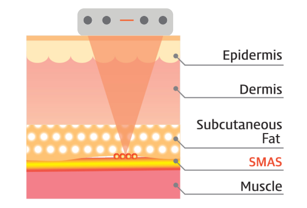SMAS คืออะไร? ทำไมต้องยกกระชับผิวถึงชั้น SMAS เพื่อให้หน้าดูอ่อนเยาว์