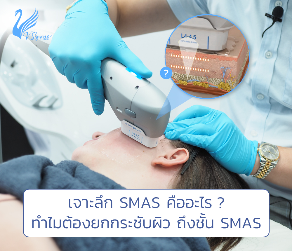 SMAS คืออะไร? ทำไมต้องยกกระชับผิวถึงชั้น SMAS เพื่อให้หน้าดูอ่อนเยาว์