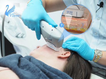 SMAS คืออะไร? ทำไมต้องยกกระชับผิวถึงชั้น SMAS เพื่อให้หน้าดูอ่อนเยาว์