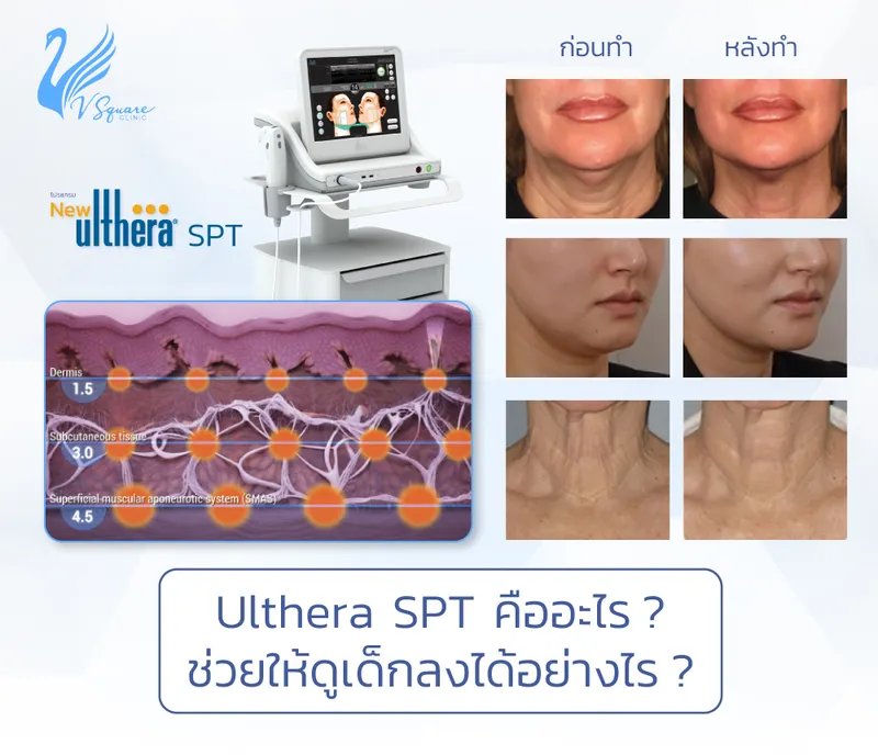 Ulthera คืออะไร? ช่วยเรื่องอะไร เจ็บไหม ราคาเท่าไร ตอบทุกข้อสงสัยที่อยากรู้