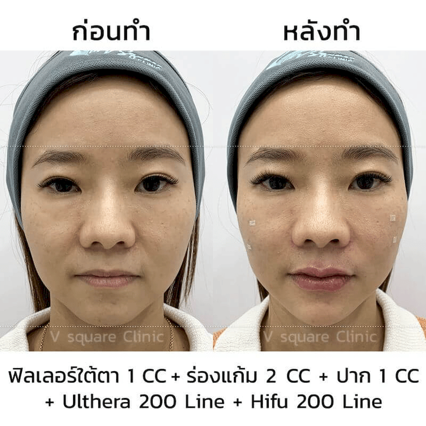 Ulthera ทำกี่ช็อต ? แต่ละตำแหน่งใช้เท่าไหร่ ? ยิ่งใช้เยอะดีจริงไหม