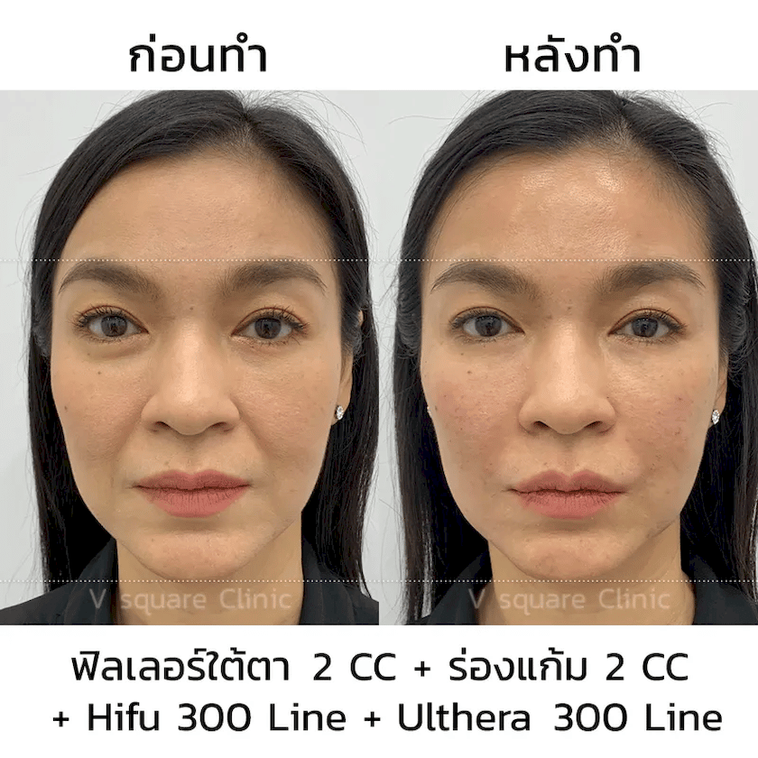 Ulthera ทำกี่ช็อต ? แต่ละตำแหน่งใช้เท่าไหร่ ? ยิ่งใช้เยอะดีจริงไหม