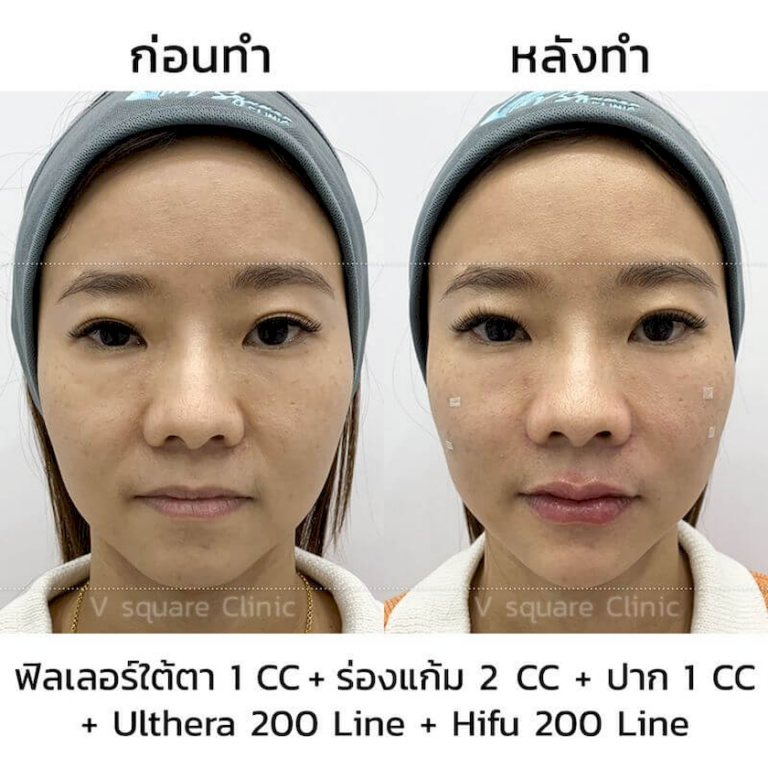 Ulthera ทำกี่ช็อต ? แต่ละตำแหน่งใช้เท่าไหร่ ? ยิ่งใช้เยอะดีจริงไหม