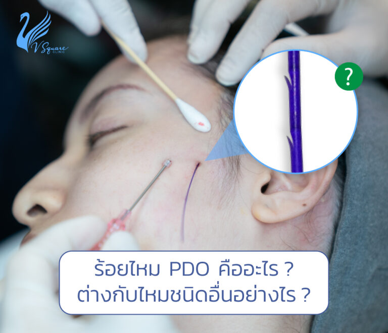 ร้อยไหม PDO คืออะไร ยกกระชับปรับหน้าเรียว ใช้ไหมแบบไหนดี