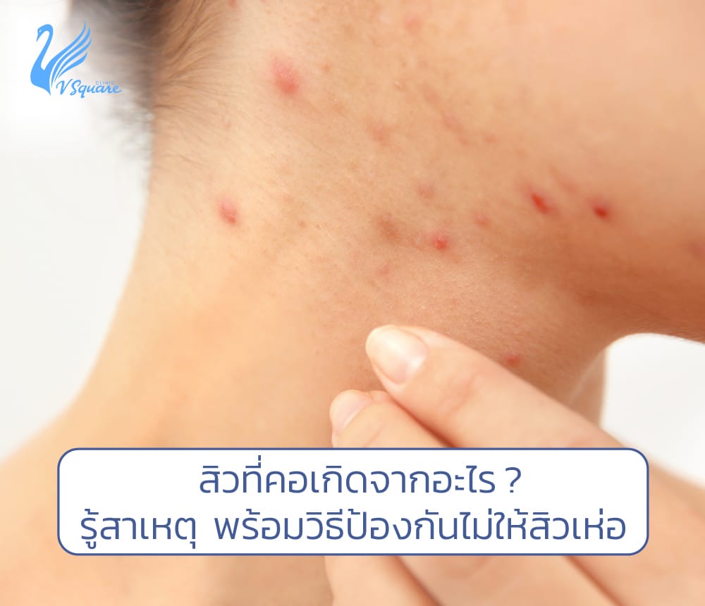 สิวที่คอเกิดจากอะไร ? รู้สาเหตุ พร้อมวิธีป้องกันไม่ให้สิวเห่อ