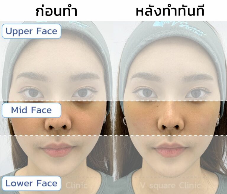 mid face คืออะไร ต้องฉีดจุดไหน ปรับรูปหน้าให้มีมิติ ดูอ่อนเยาว์