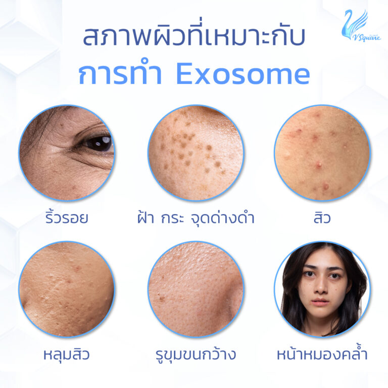exosome คืออะไร ? ราคาเท่าไหร่ ตัวเลือกที่ดีที่สุด จริงไหม