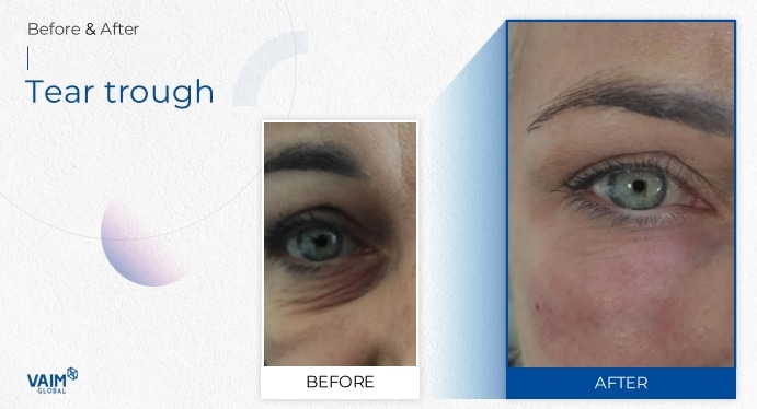 ไหมน้ำ Juvelook คืออะไร ? รีวิวข้อมูลครบ จบในบทความเดียว