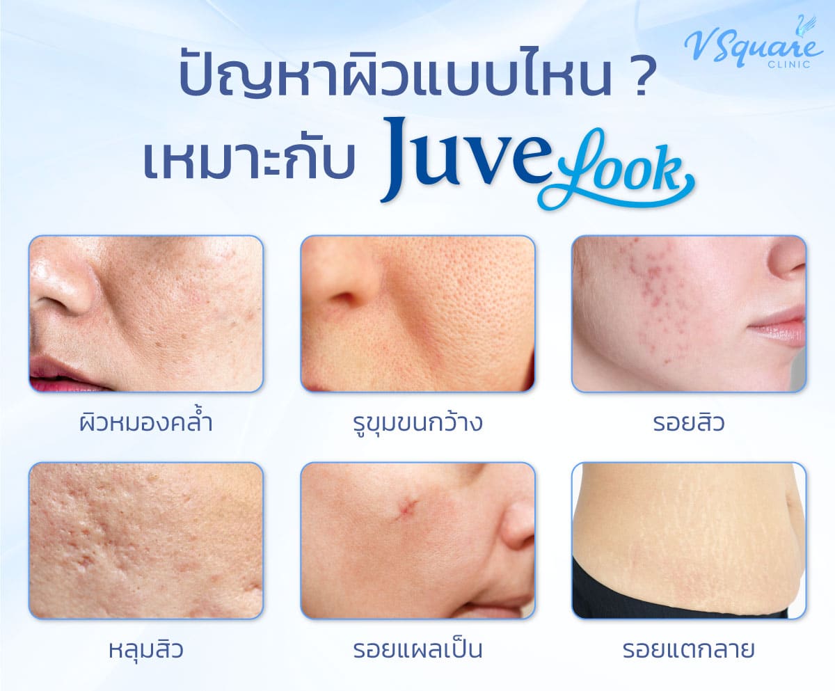 ไหมน้ำ Juvelook คืออะไร ? รีวิวข้อมูลครบ จบในบทความเดียว