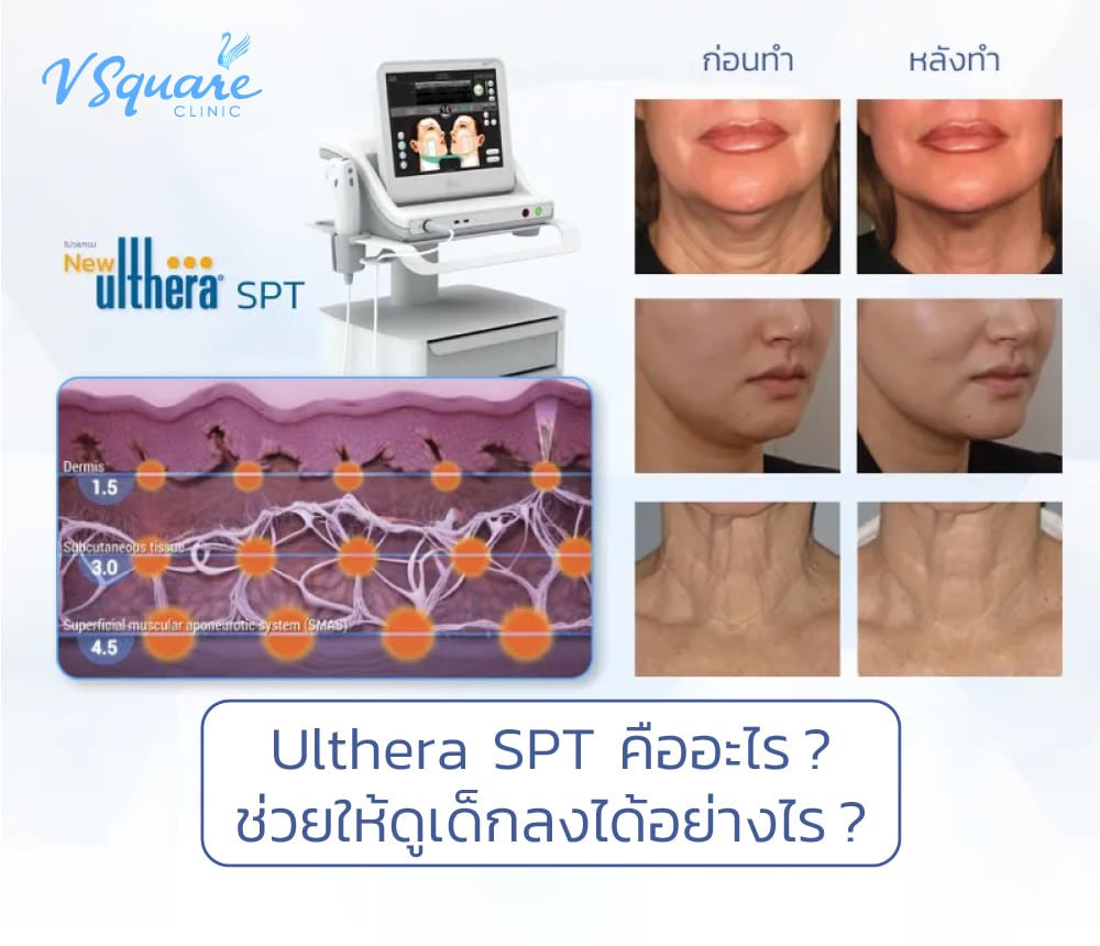 Ulthera คืออะไร? ช่วยเรื่องอะไร เจ็บไหม ราคาเท่าไร ตอบทุกข้อสงสัยที่อยากรู้