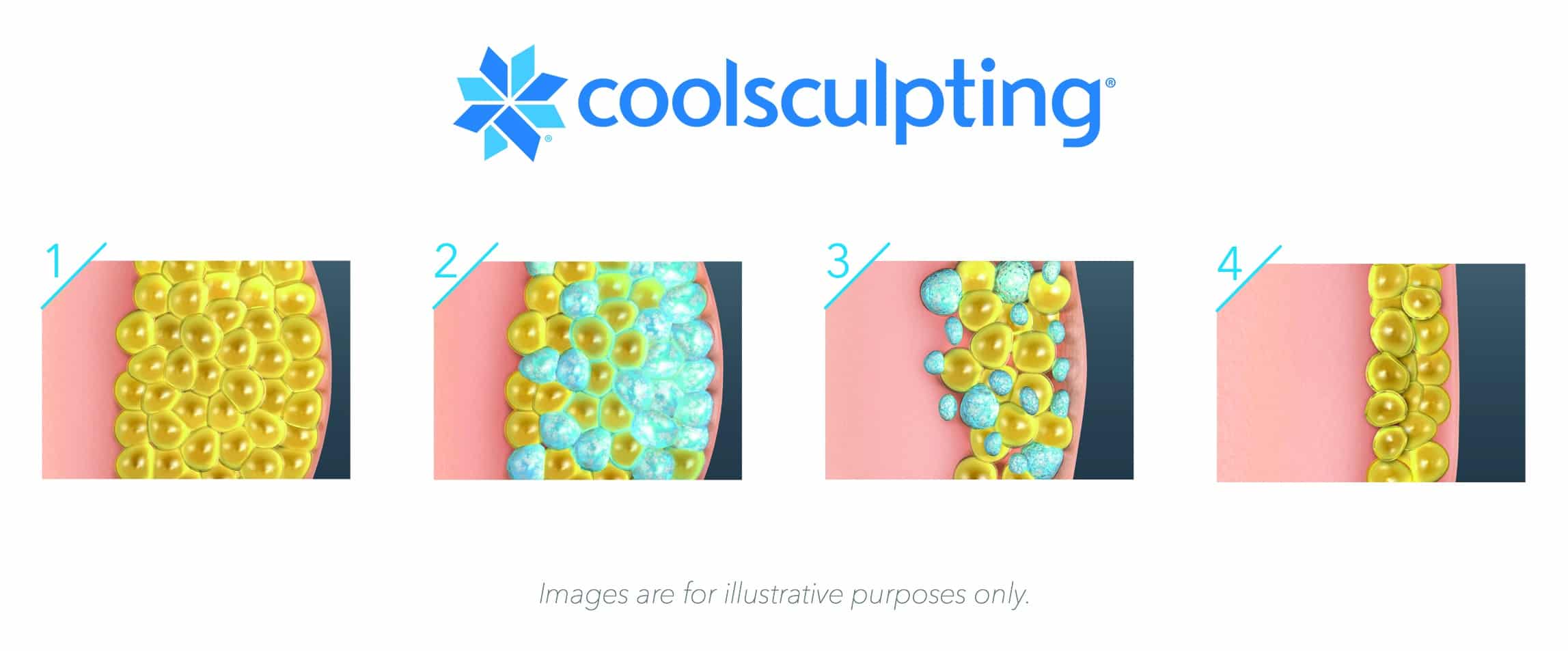 Coolsculpting กำจัดไขมันด้วยความเย็น ทางเลือกใหม่ของการลดหุ่นให้เพรียวสวย