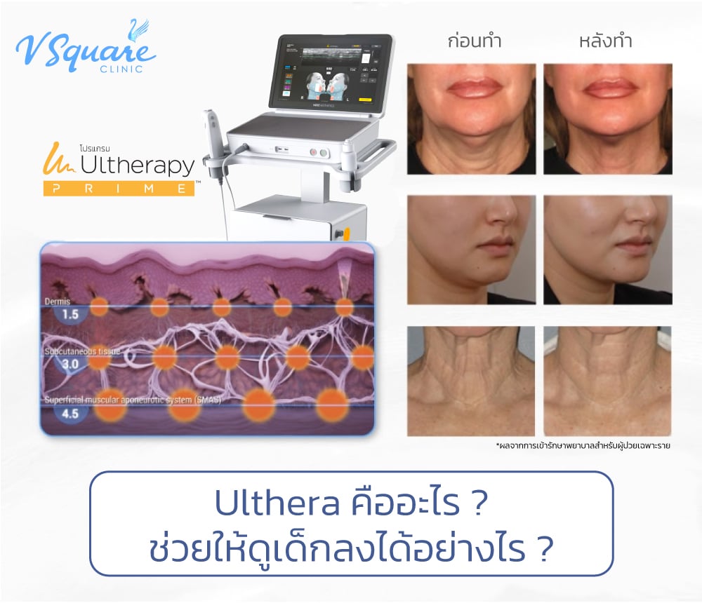 Ulthera คืออะไร? ช่วยเรื่องอะไร เจ็บไหม ราคาเท่าไร ตอบทุกข้อสงสัยที่อยากรู้