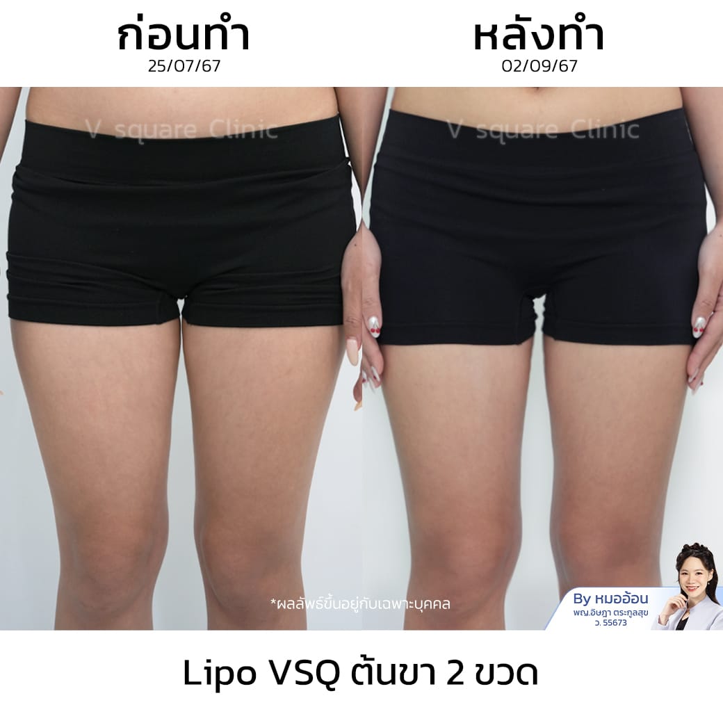 Lipo V VSQ ลดไขมันเห็นผลตั้งแต่ครั้งแรก อยู่ได้นาน 6 เดือน