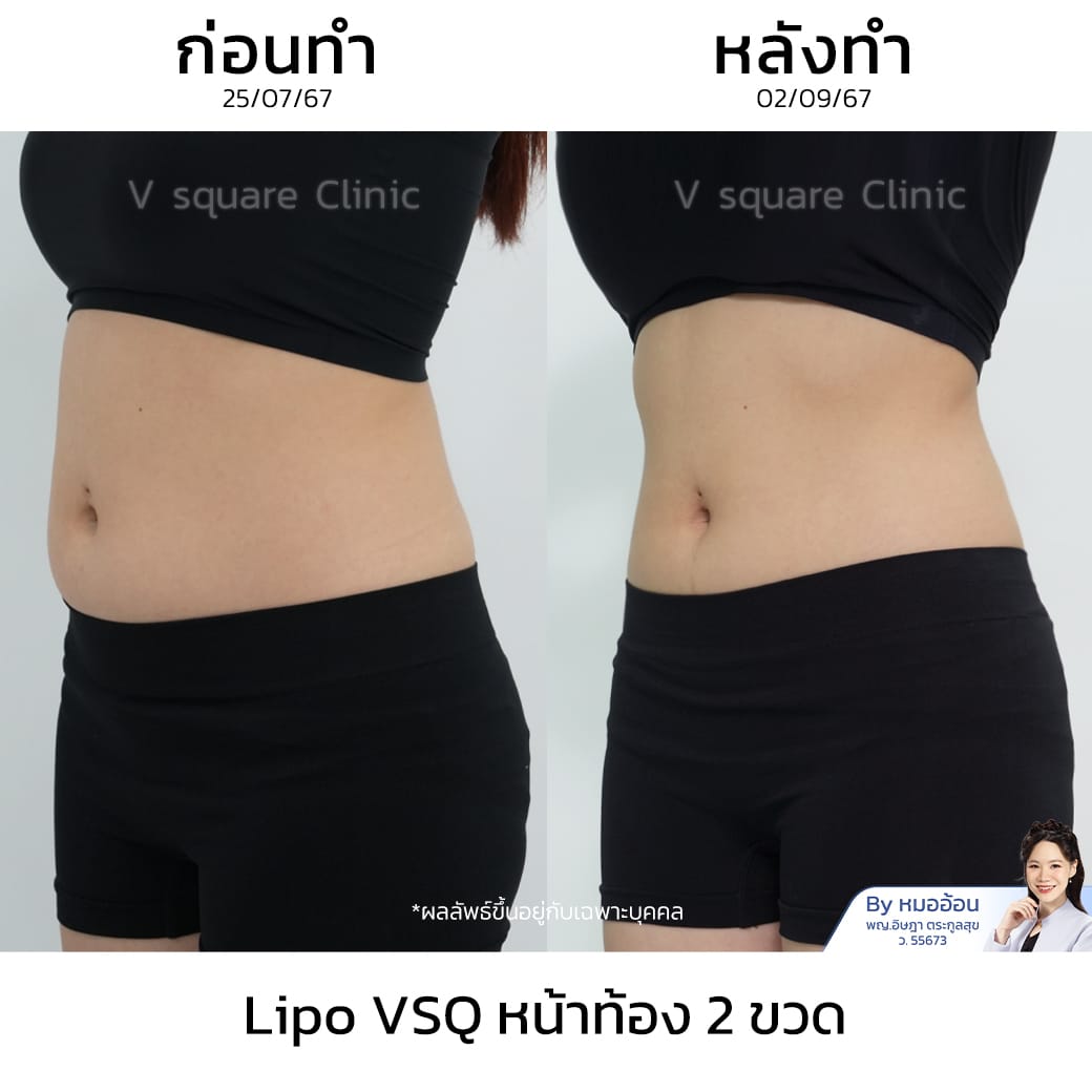 Lipo V VSQ ลดไขมันเห็นผลตั้งแต่ครั้งแรก อยู่ได้นาน 6 เดือน
