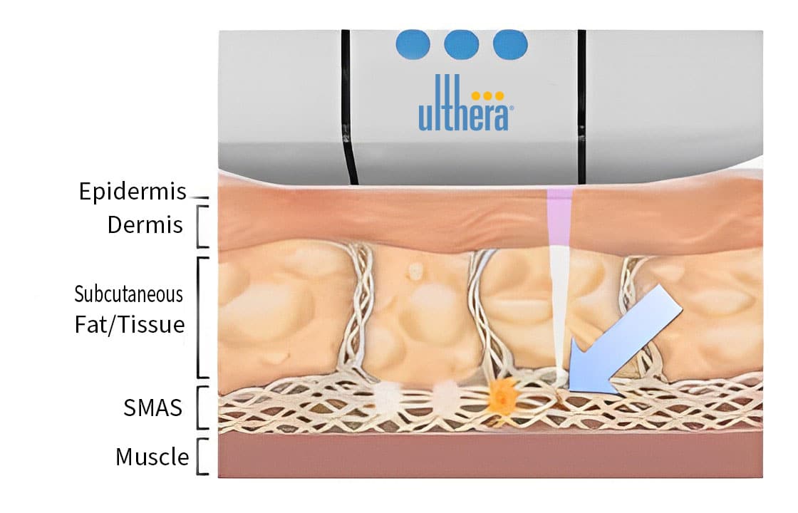 Sofwave กับ Ulthera ต่างกันอย่างไร เครื่องไหนเหมาะกับใคร