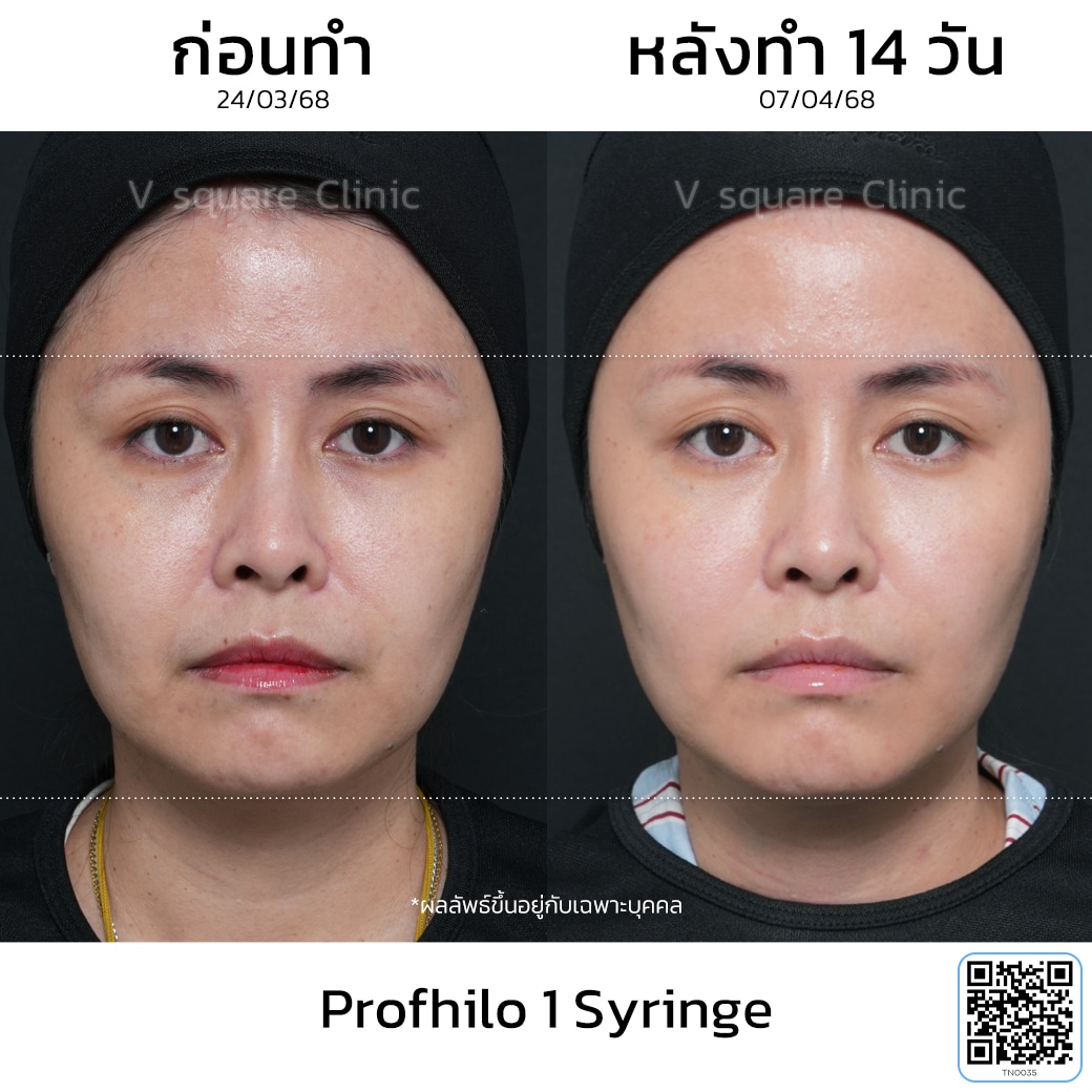 Profhilo คืออะไร เหมาะกับใคร ? ทุกเรื่องที่ควรรู้ก่อนตัดสินใจฉีด