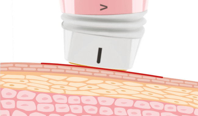 Volnewmer คืออะไร ราคาเท่าไหร่ เครื่องยกกระชับ ผิวเฟิร์ม