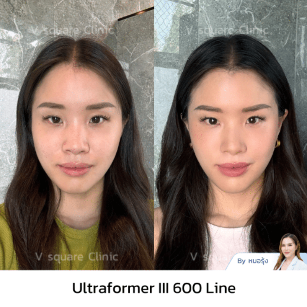 Ultraformer iii ราคาเท่าไร ? จำนวนการยิงมากน้อยต่างกันอย่างไร