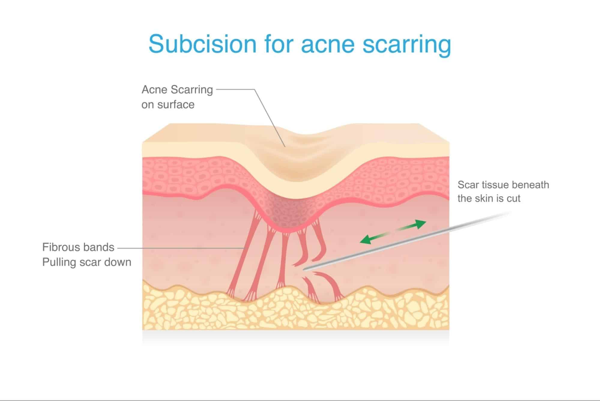 8 วิธีแก้หน้าไม่เรียบเนียน ด้วยเทคนิคแพทย์ผิวหนัง