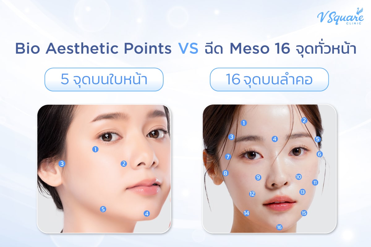 เทคนิค Bio Aesthetic Points ฉีดน้อยจุด แต่ผิวดีทั่วหน้า