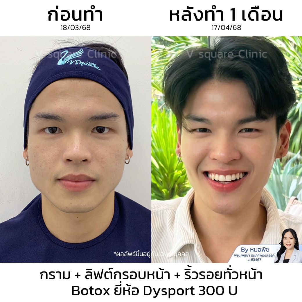 Masseter Botox: When Results Show & How to Make It Work Fast
