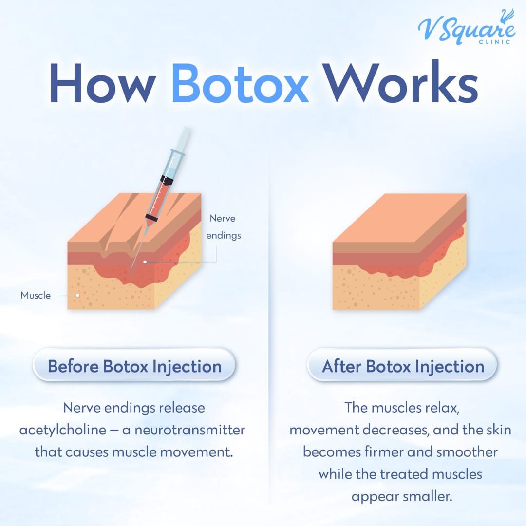 Botox Injections: What They Are, Benefits & How Long They Last