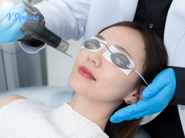 Laser Dark Spots – Safe, Effective Pigmentation Removal