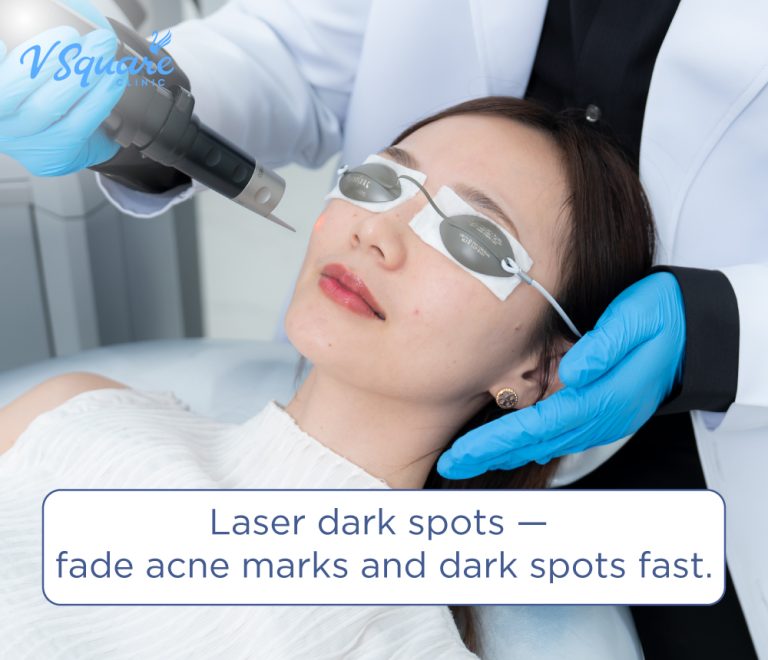 Laser Dark Spots – Safe, Effective Pigmentation Removal