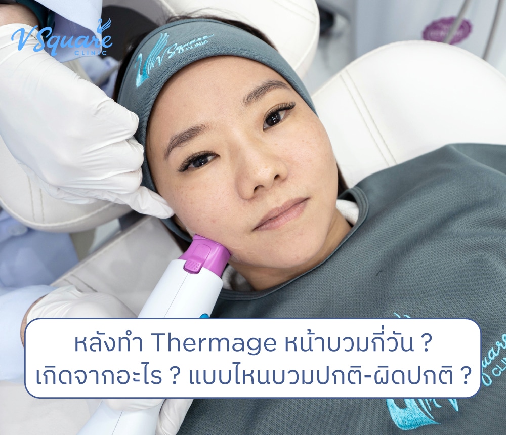 Thermage หน้าบวมกี่วัน ? บวมแบบไหนควรระวัง เช็กอาการหลังทำ